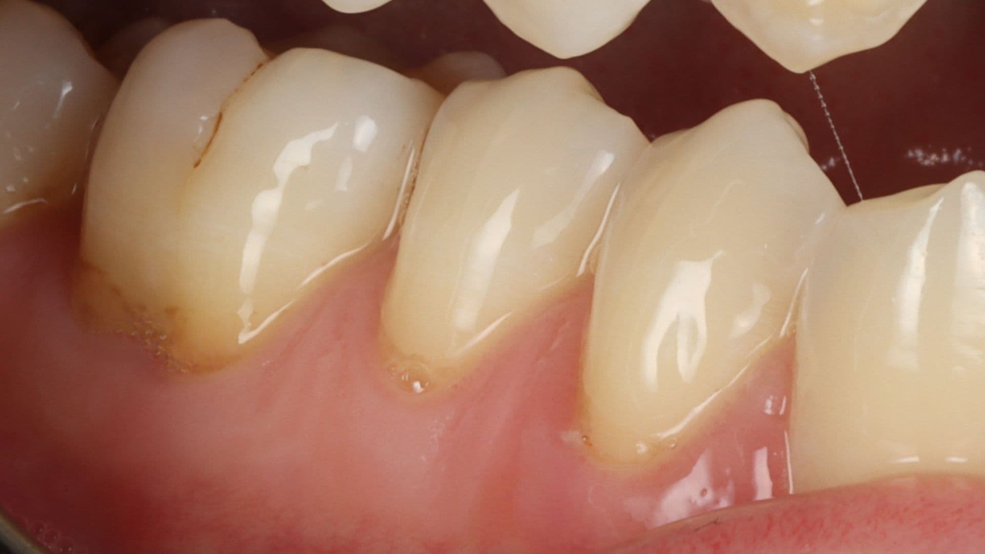 Exposed Tooth Root Pictures | What to Look For + Signs