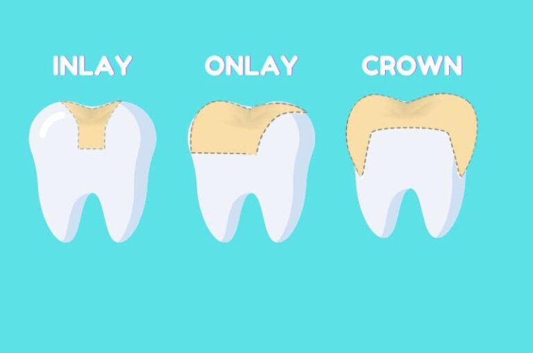 Inlays and Onlays North York ON | Gentle Tooth Repair