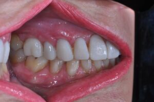 Exposed Tooth Root Pictures | What to Look For + Signs