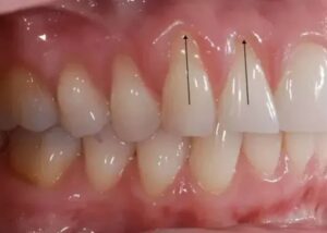 Exposed Tooth Root Pictures | What to Look For + Signs