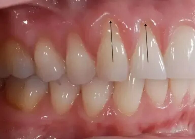 Exposed Tooth Root Pictures | What to Look For + Signs