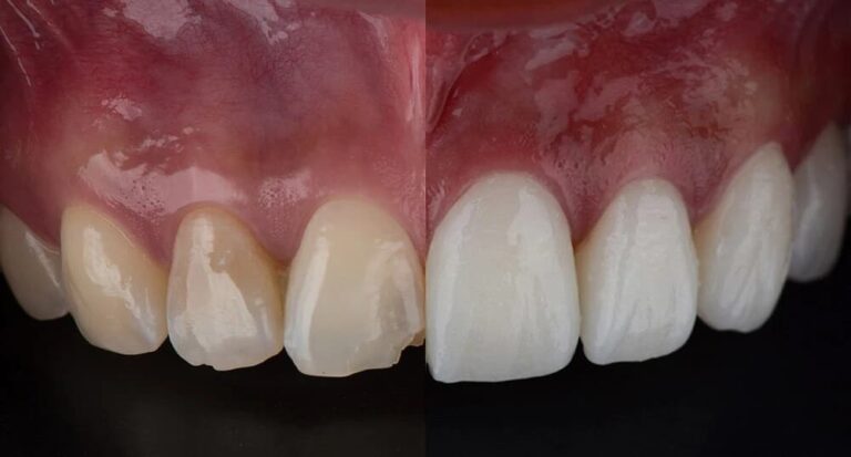 Composite vs Porcelain Veneers: Which One Is Right for You?