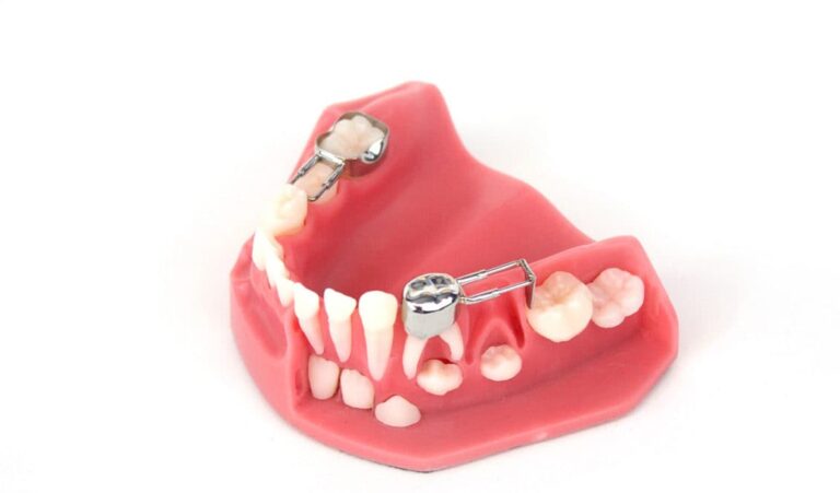 What Is a Dental Space Maintainer and Why Is It Important?