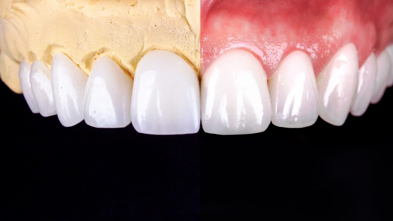 Composite vs Porcelain Veneers: Which One Is Right for You?
