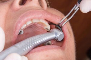 Types of Dental Fillings & Material: Which One to Choose?
