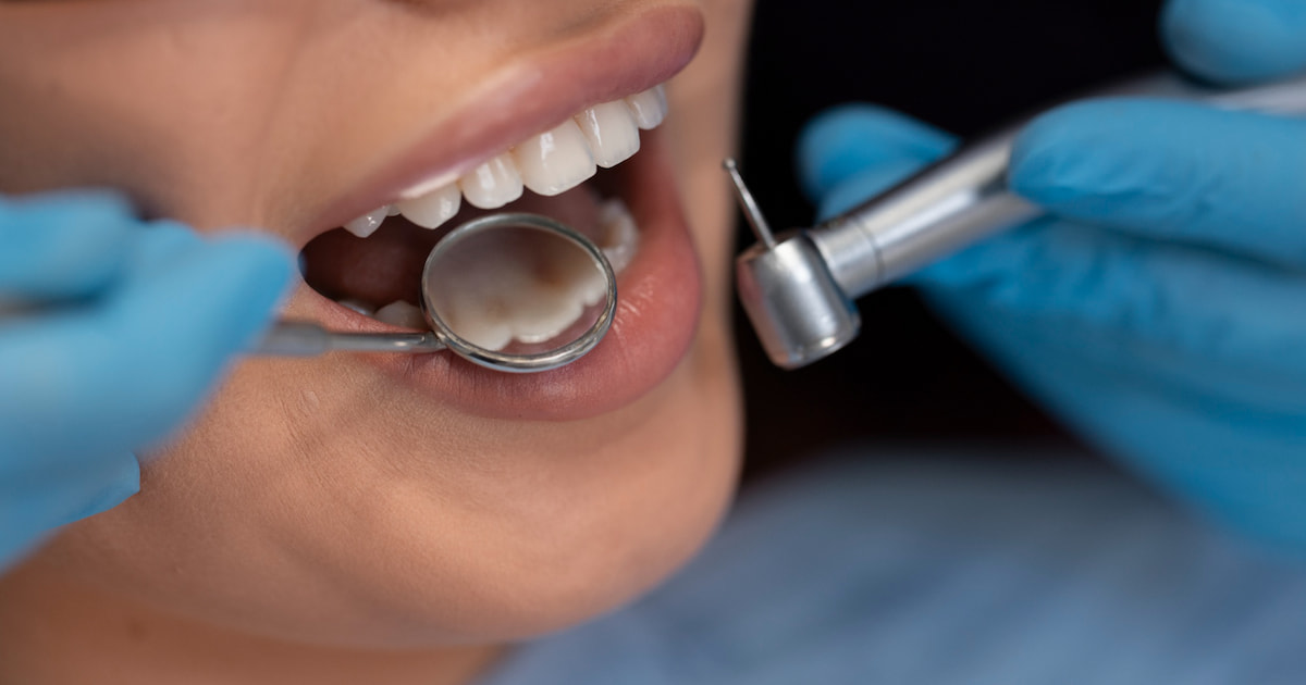 Temporary Tooth Filling: Materials, Lifespan & Care Tips