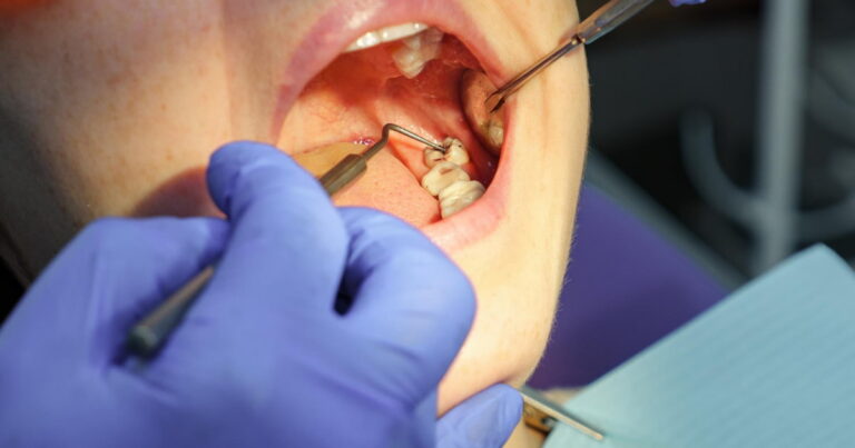 Tooth Extraction Infection: Symptoms, Prevention & Treatment Guide